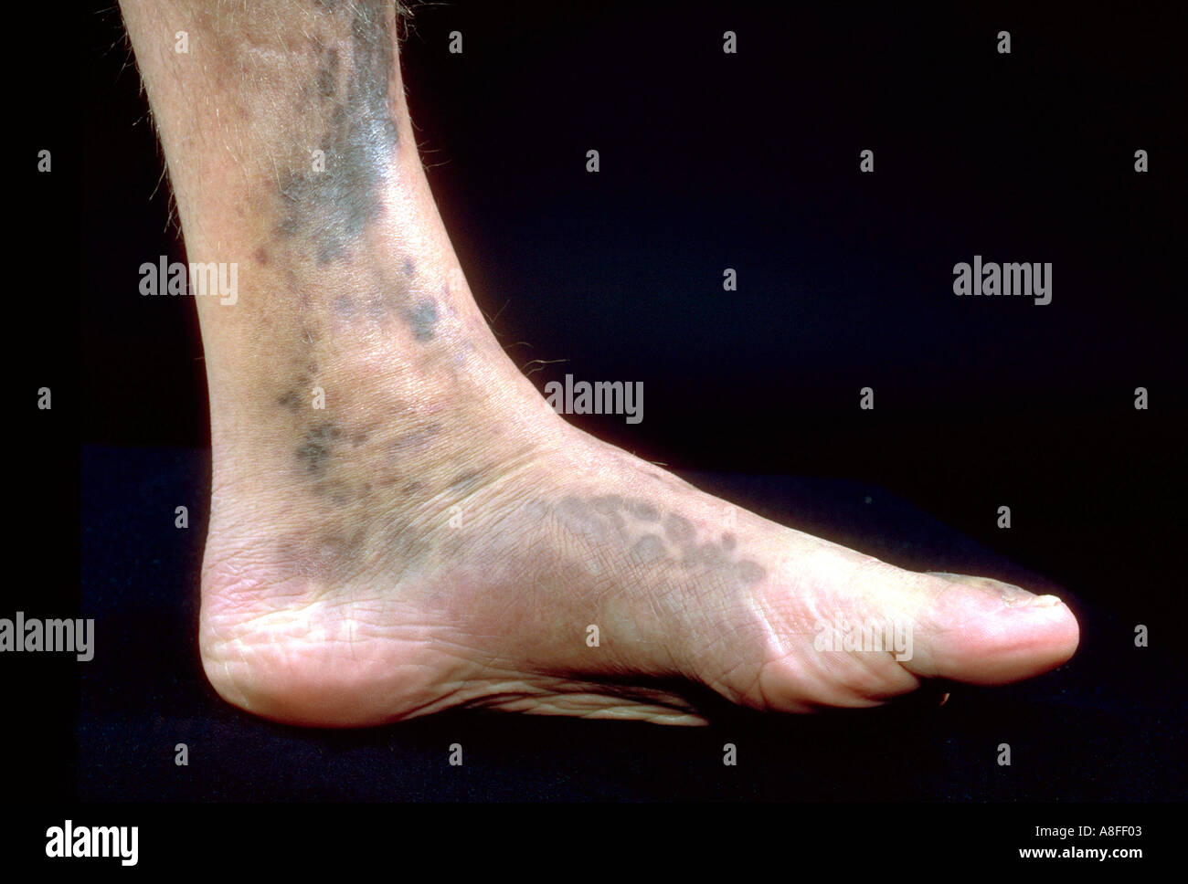 Lesioni da sarcoma immagini e fotografie stock ad alta risoluzione - Alamy