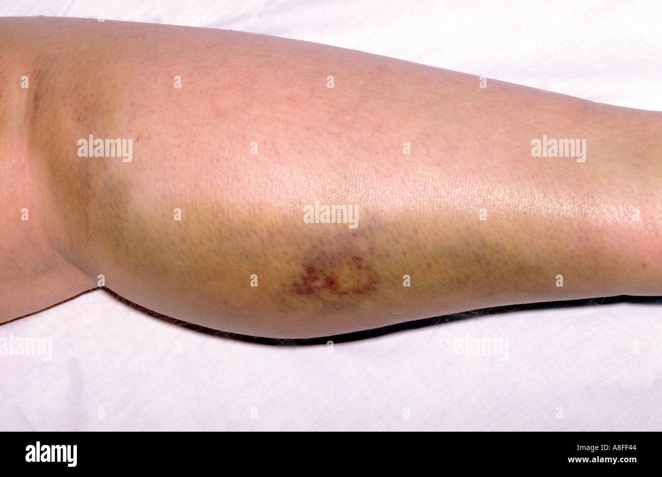 La trombosi venosa profonda TVP Foto stock - Alamy
