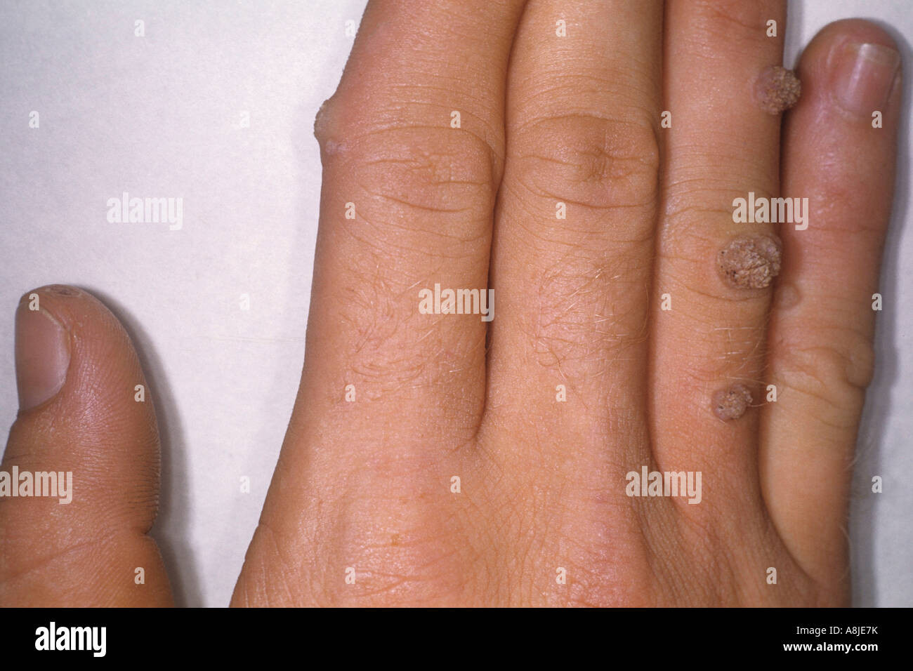 Hpv human papilloma virus immagini e fotografie stock ad alta ...