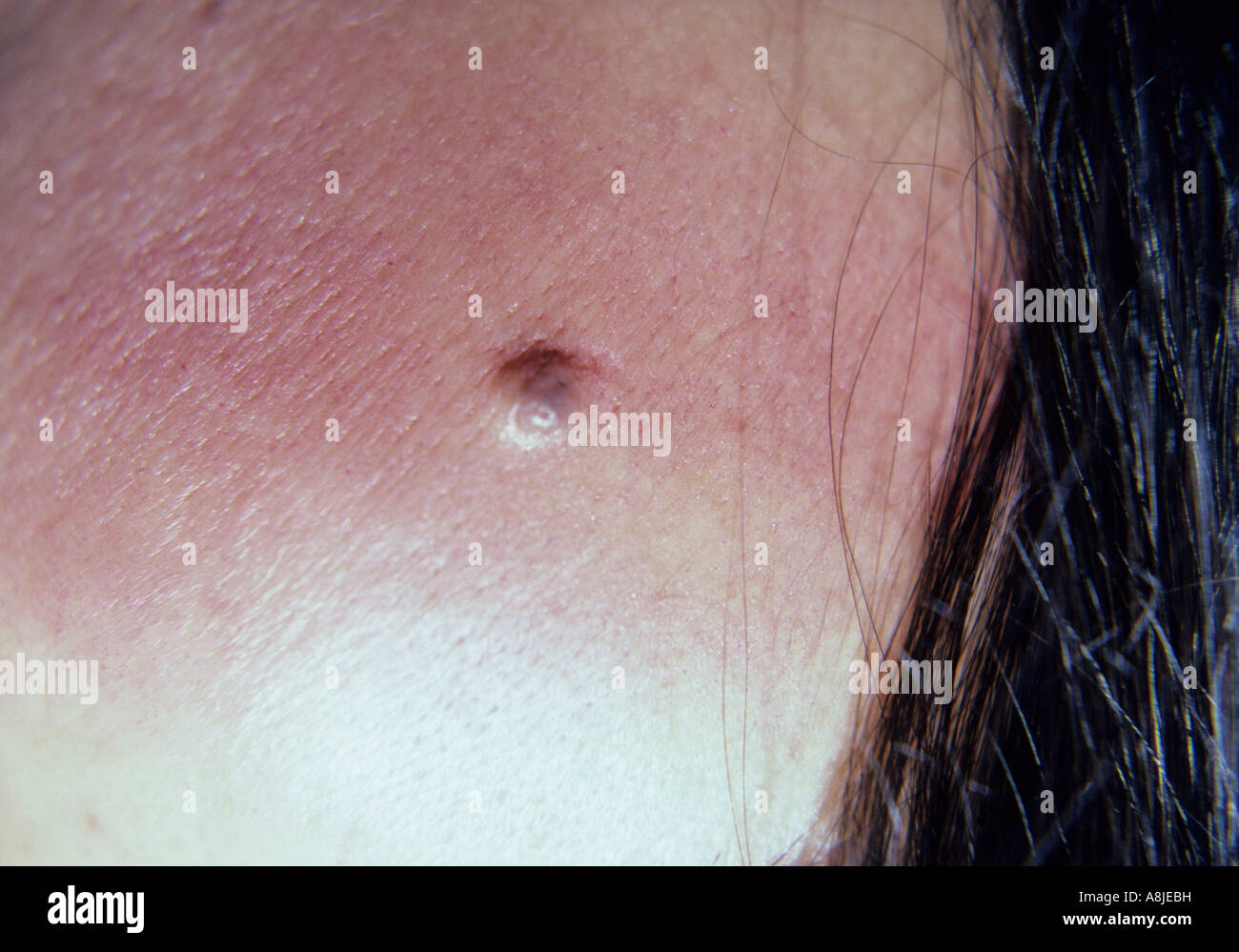 Benign nevus skin dermatology immagini e fotografie stock ad alta ...