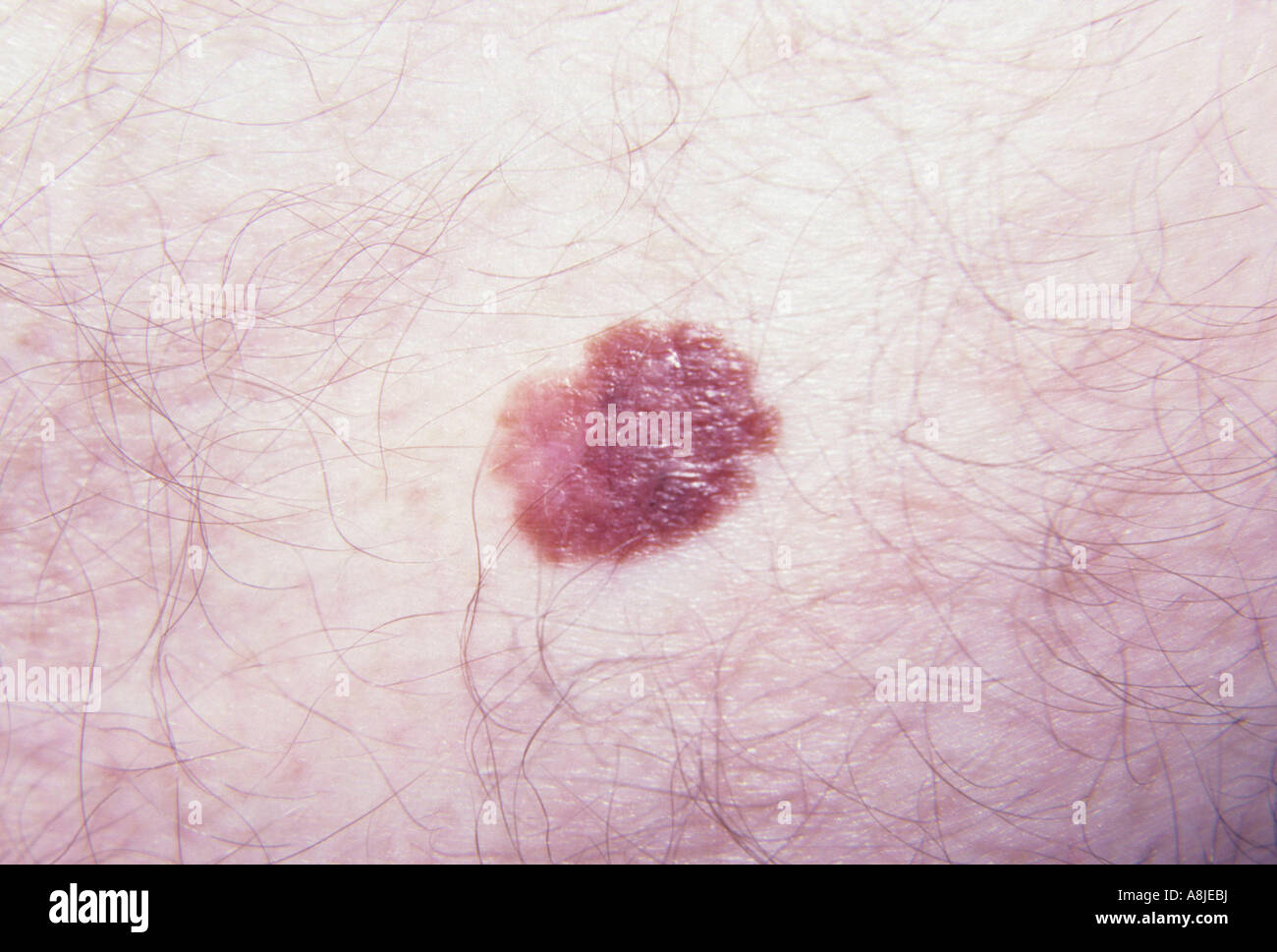 Benign nevus skin dermatology immagini e fotografie stock ad alta ...