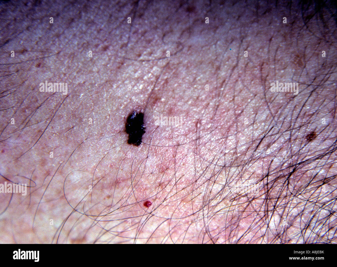 Benign nevus skin dermatology immagini e fotografie stock ad alta ...