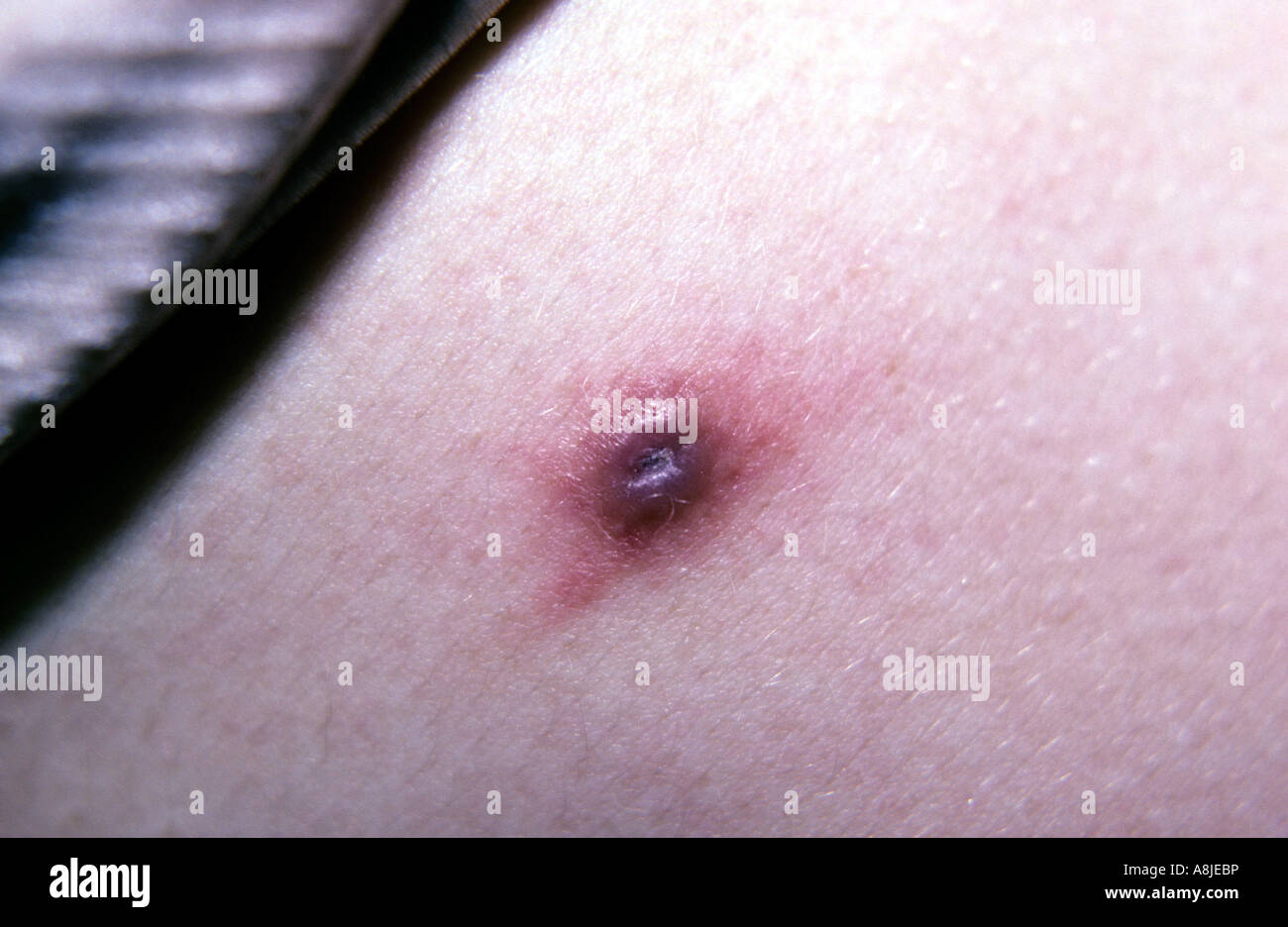 Benign nevus skin dermatology immagini e fotografie stock ad alta ...