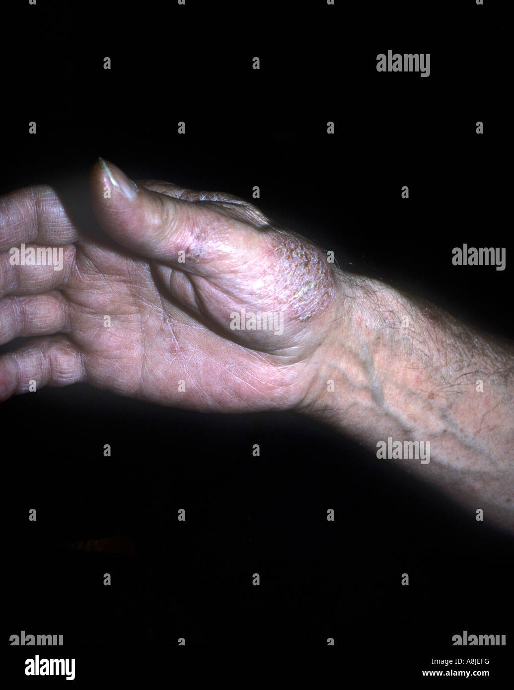 Nummular eczema immagini e fotografie stock ad alta risoluzione - Alamy