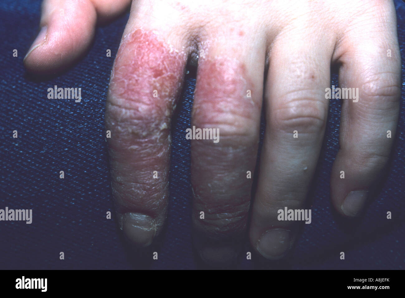 Nummular eczema dermatology skin immagini e fotografie stock ad alta ...