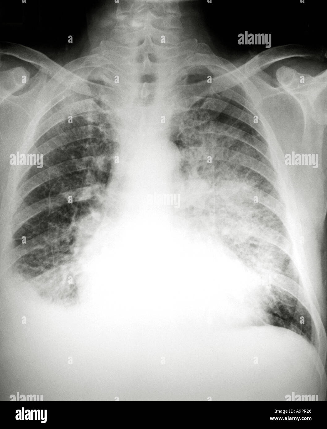 Radiografia del torace normale immagini e fotografie stock ad alta ...