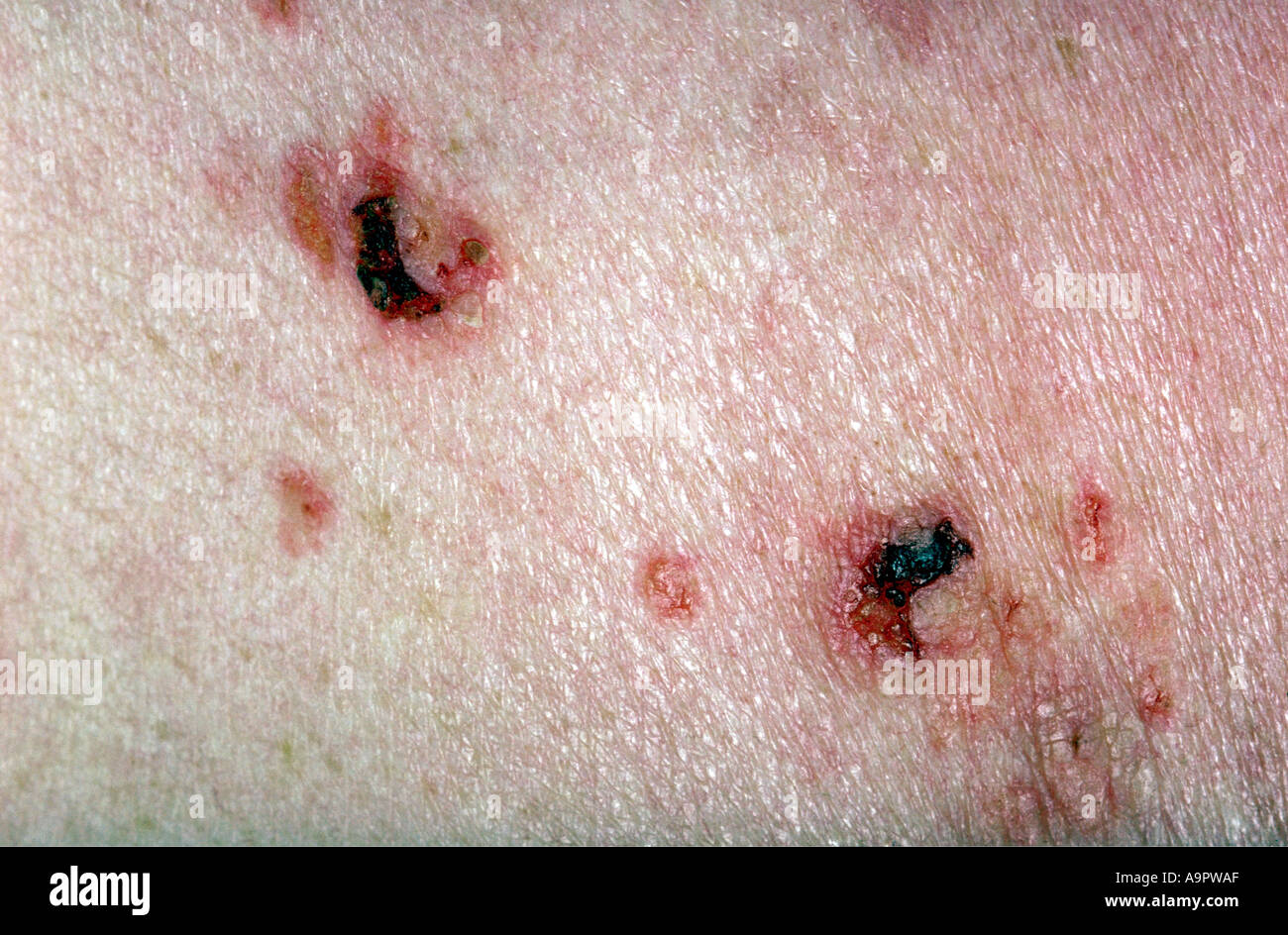 Pemfigo volgare immagini e fotografie stock ad alta risoluzione - Alamy