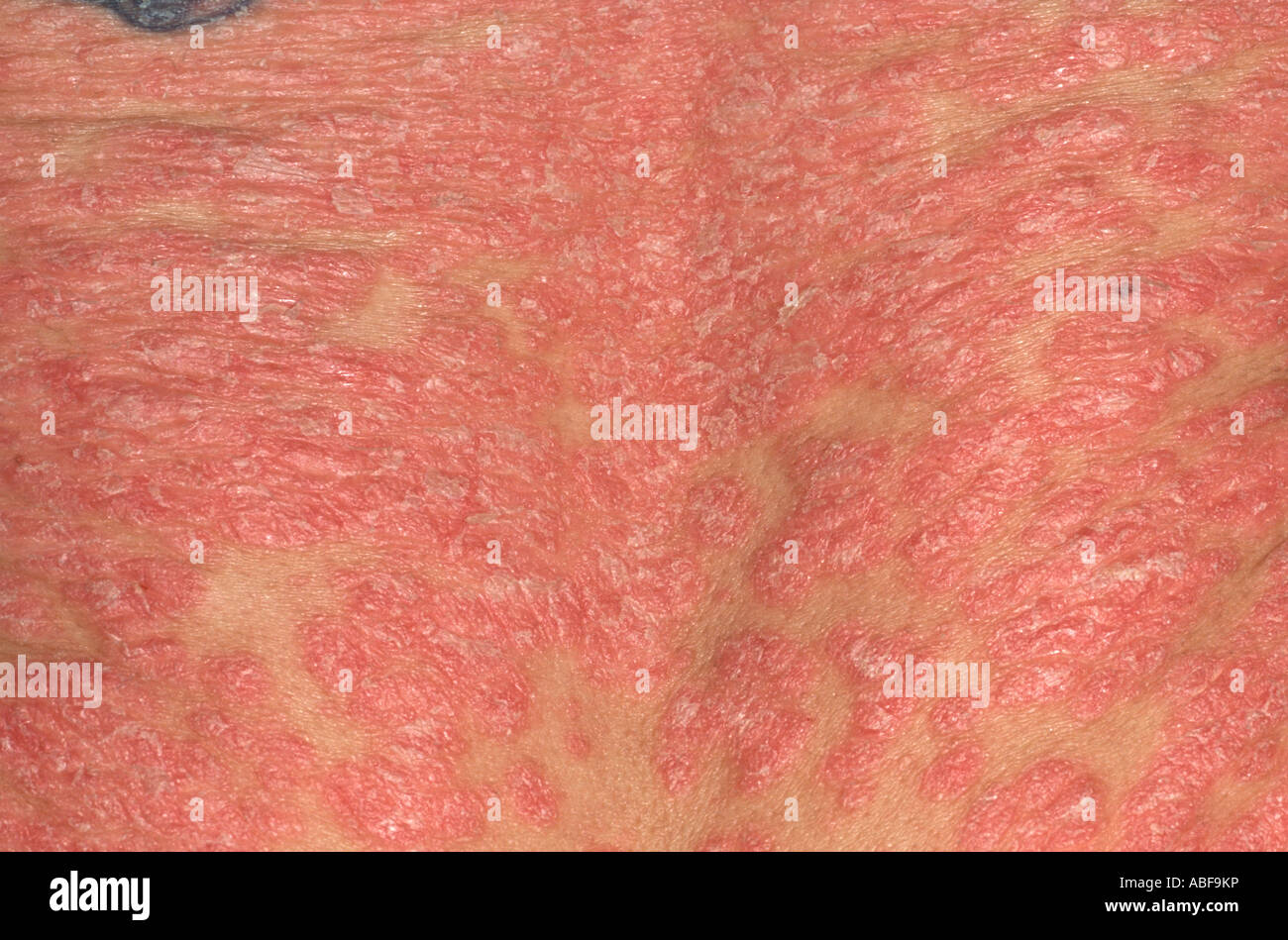 Placche di psoriasi immagini e fotografie stock ad alta risoluzione - Alamy