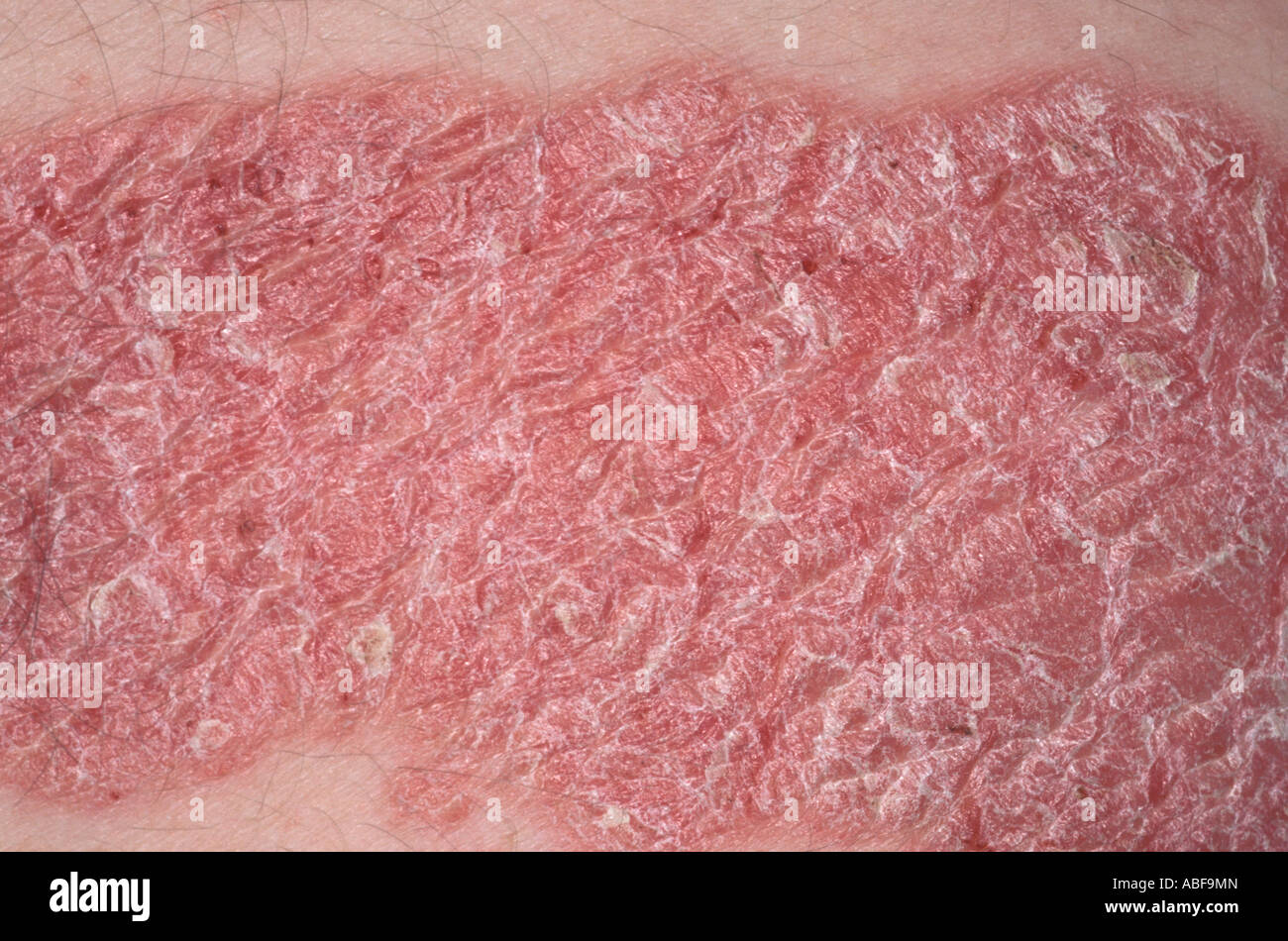 Placche di psoriasi immagini e fotografie stock ad alta risoluzione - Alamy