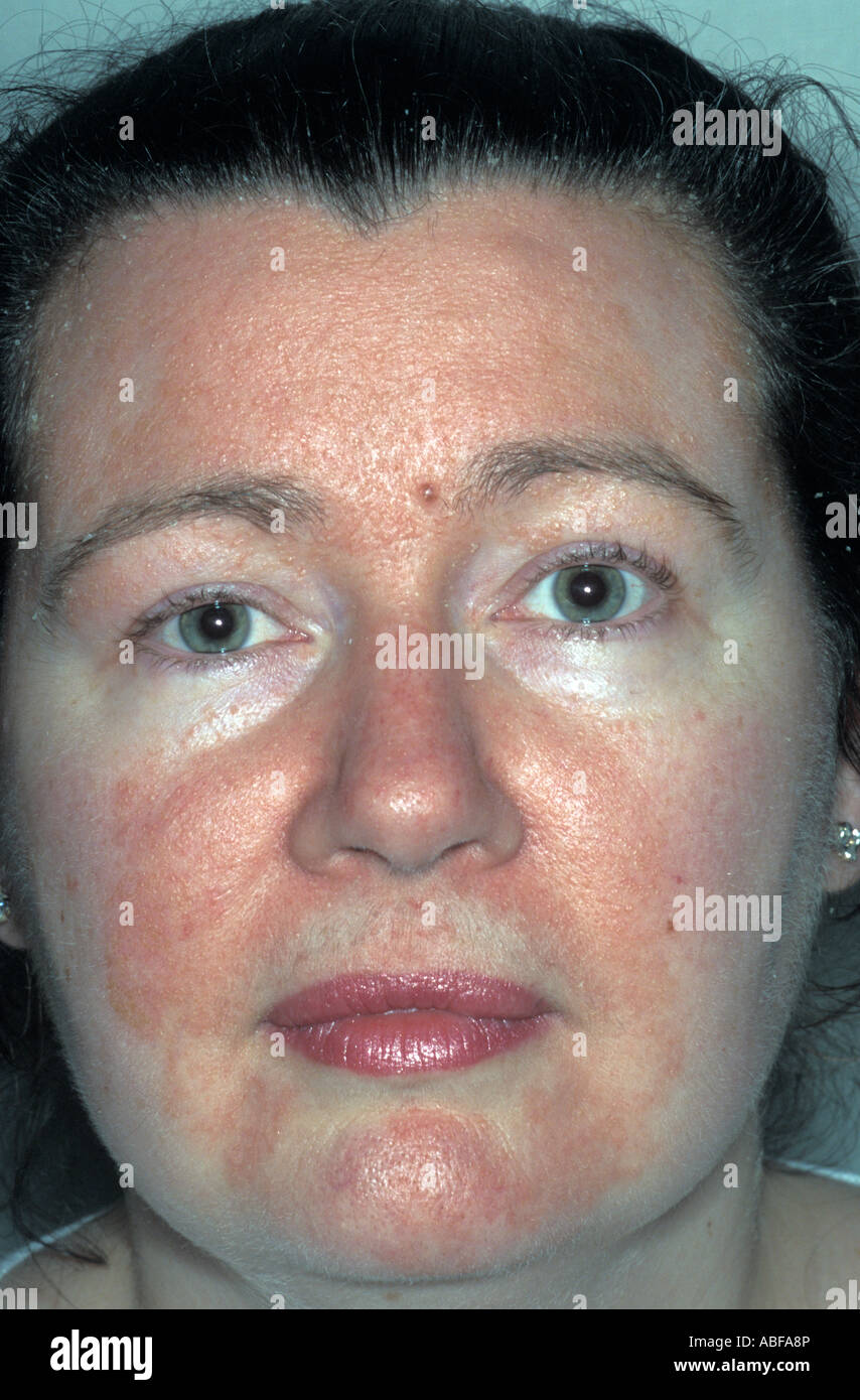 Scaling Rash Immagini e Fotos Stock - Alamy