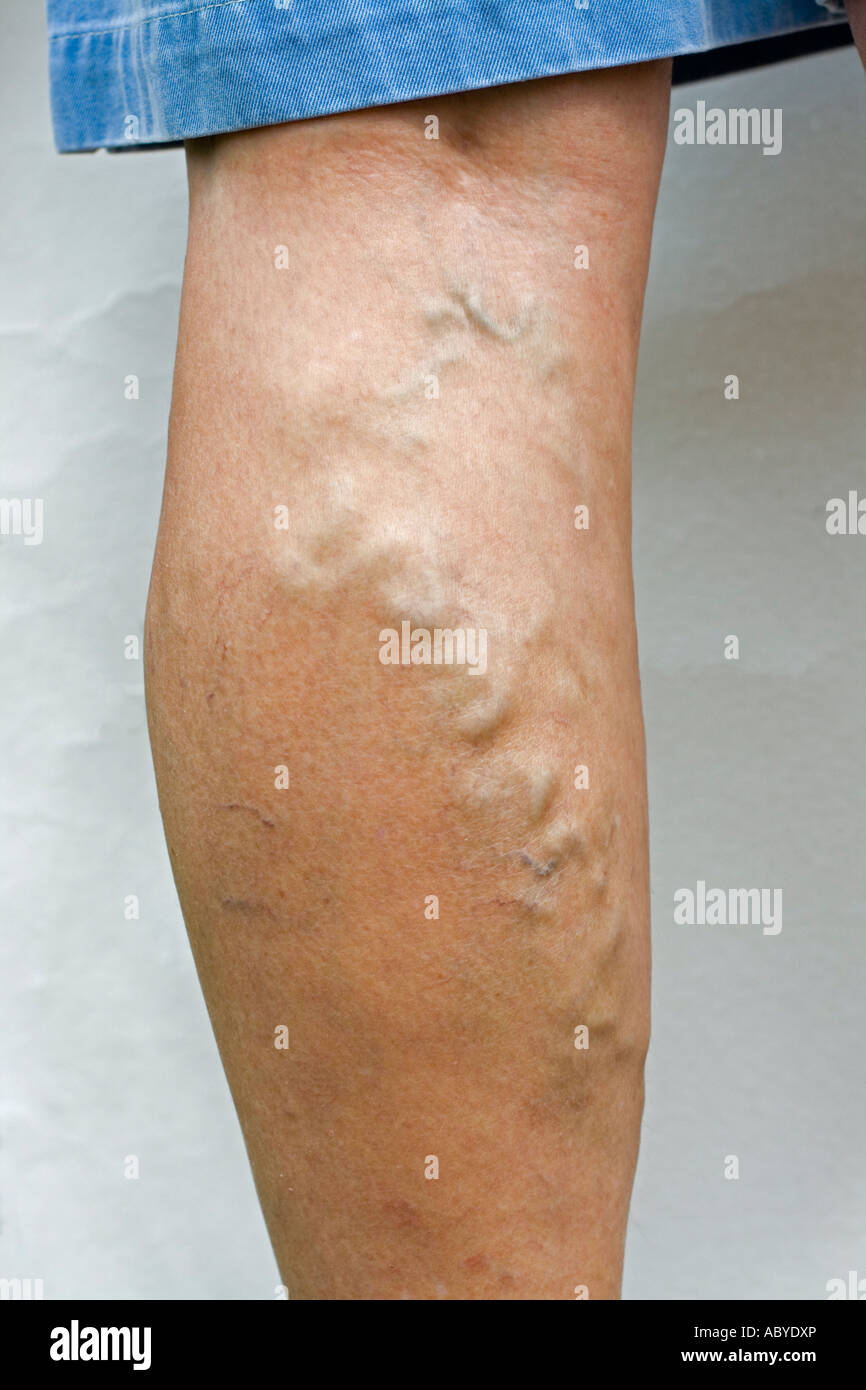 Donna del sangue della gamba dilatata immagini e fotografie stock ad ...