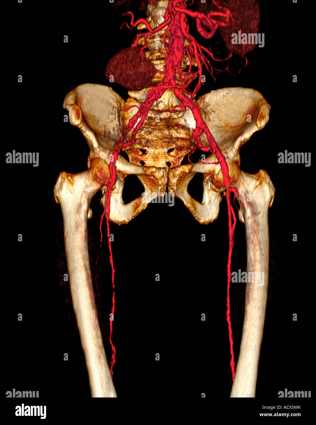 3D CT scan mostra 83 anni con femmina diritto arteria iliaca occlusione ...