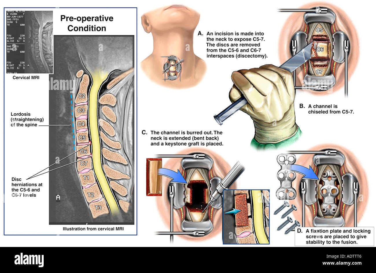 Cervical incision immagini e fotografie stock ad alta risoluzione - Alamy