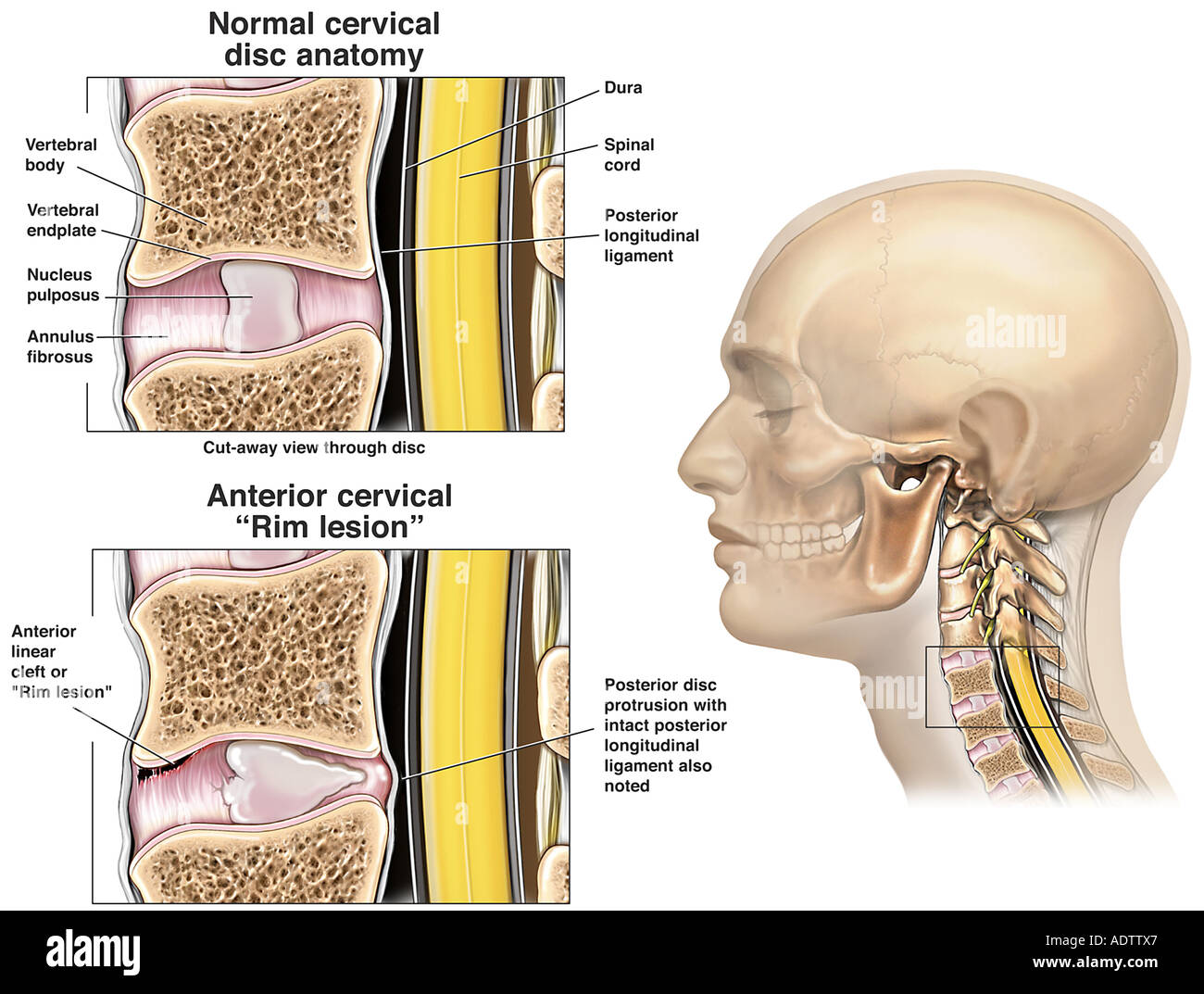Iperflessione cervicale immagini e fotografie stock ad alta risoluzione ...