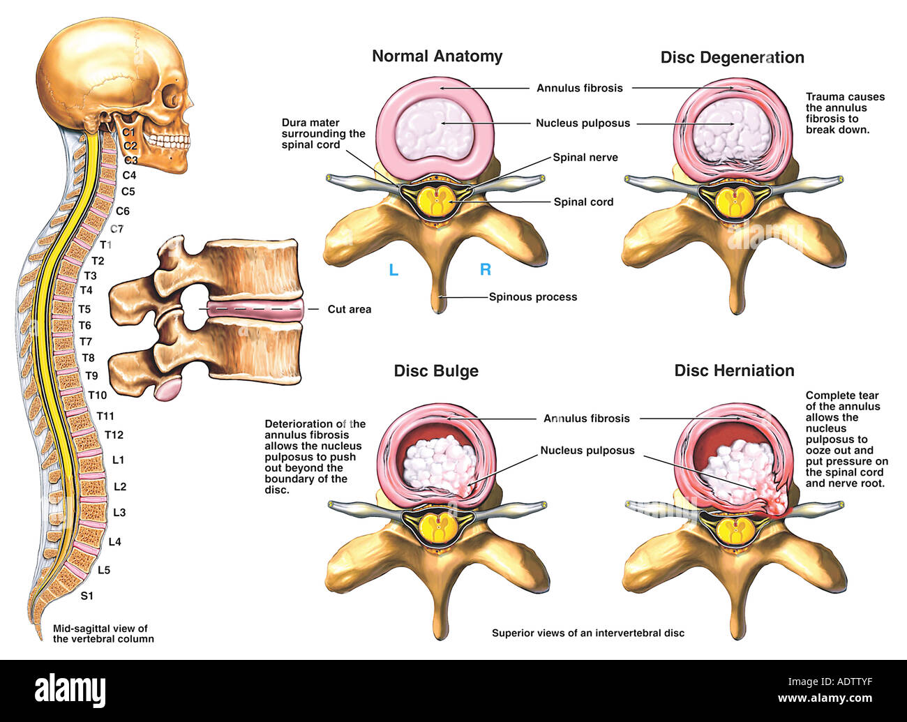 Lesione Del Disco Intervertebrale Immagini e Fotos Stock - Alamy