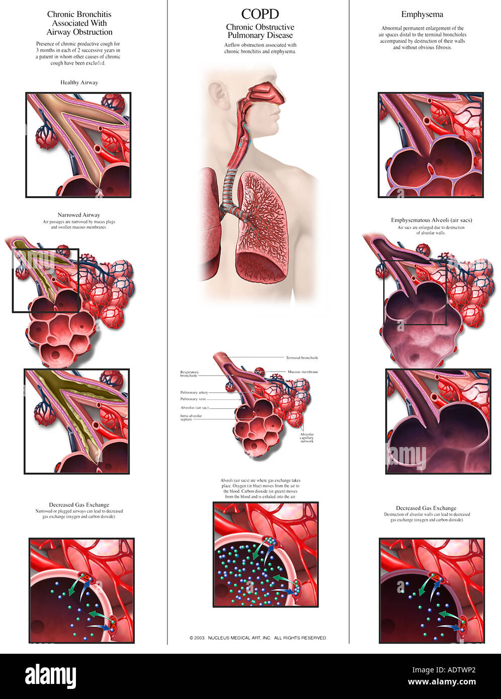 Chronic obstructive pulmonary disease immagini e fotografie stock ad ...
