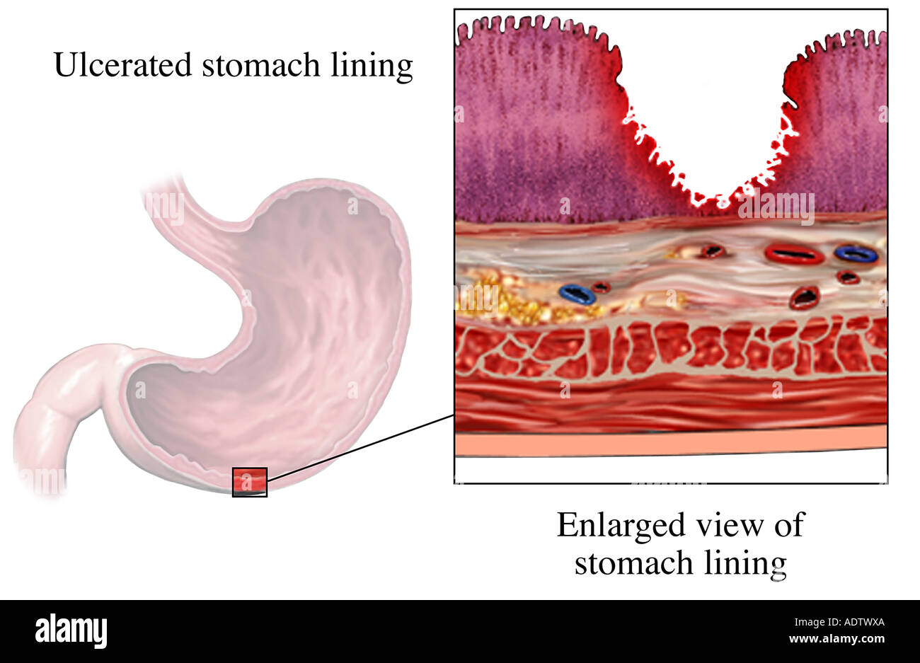 Ulcera duodenale immagini e fotografie stock ad alta risoluzione - Alamy