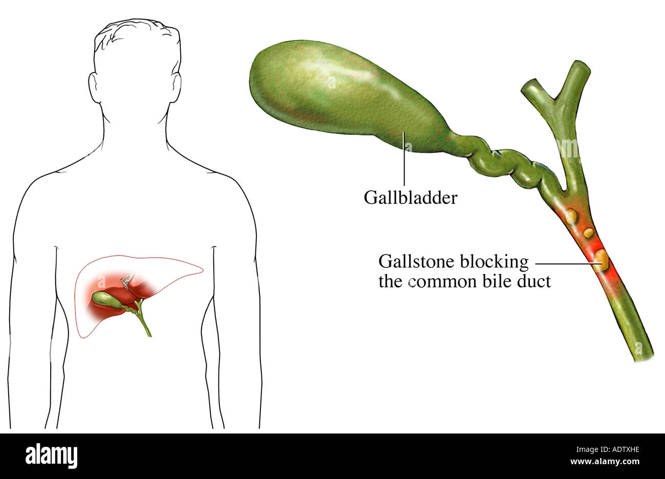 Common Bile Ducts Immagini e Fotos Stock - Alamy