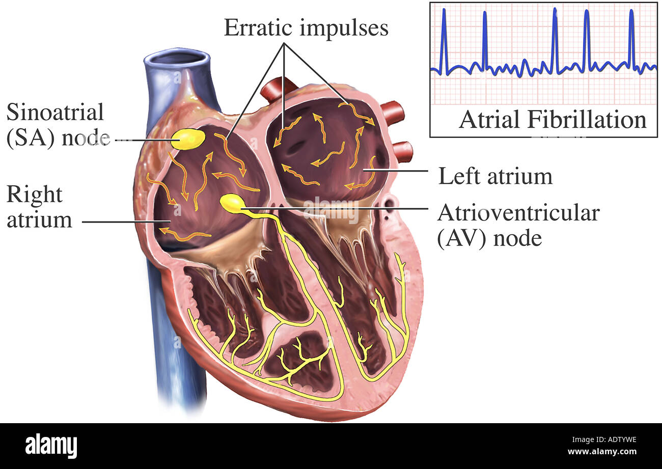 Fibrillazione atriale cardiaca immagini e fotografie stock ad alta ...