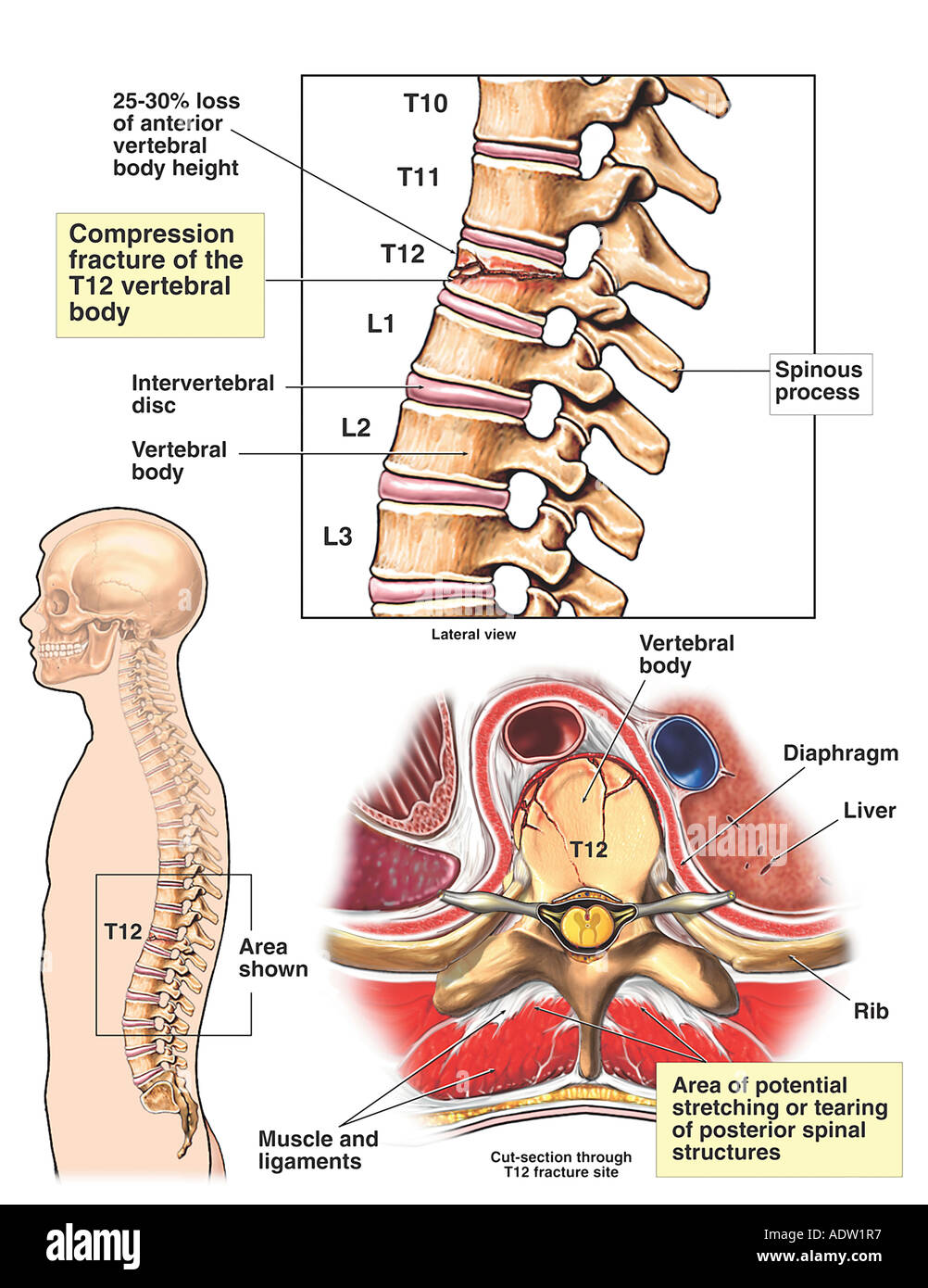 Vertebral fracture