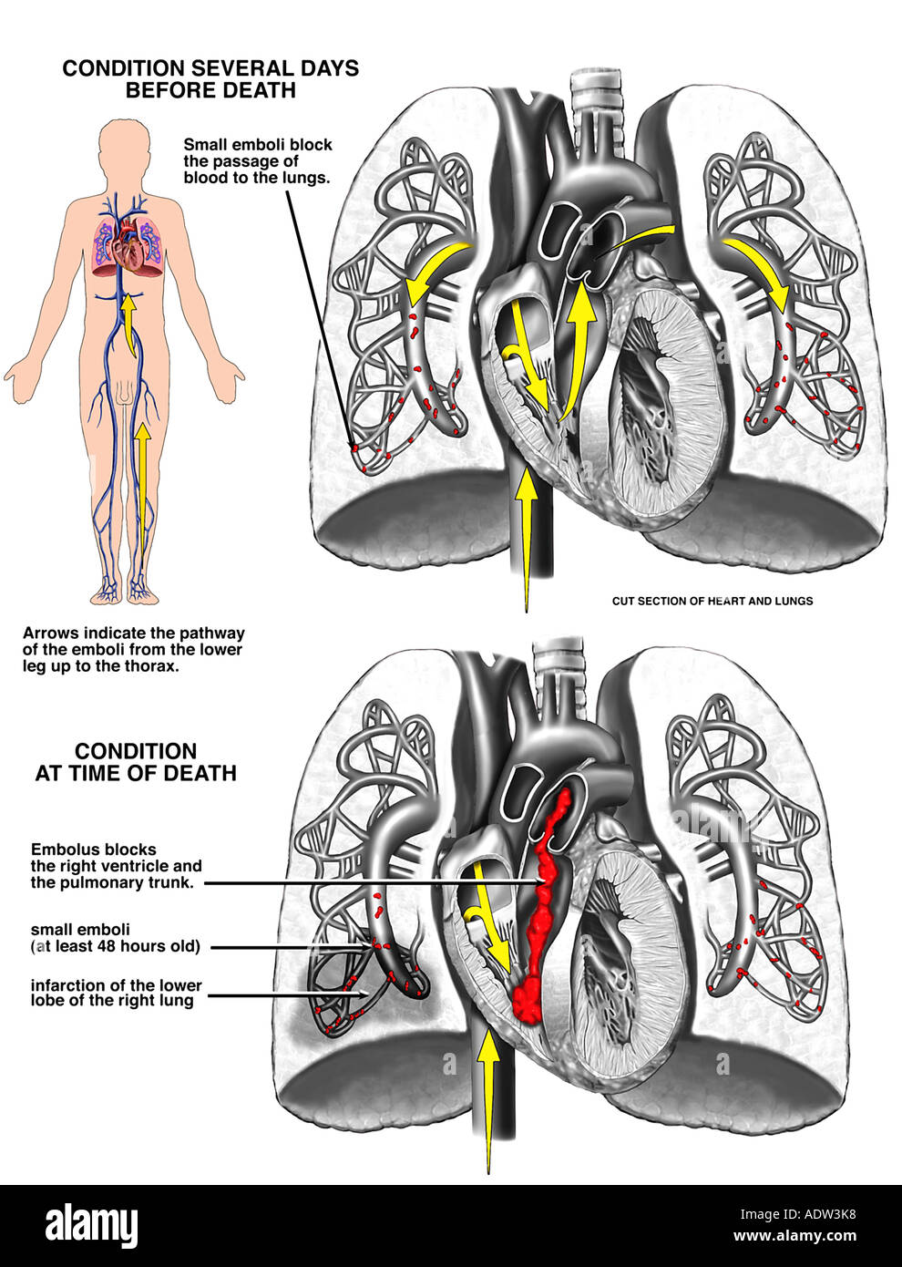 Embolia polmonare immagini e fotografie stock ad alta risoluzione - Alamy