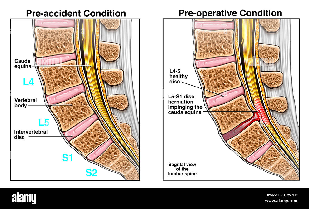 Disk herniation lumbar immagini e fotografie stock ad alta risoluzione ...