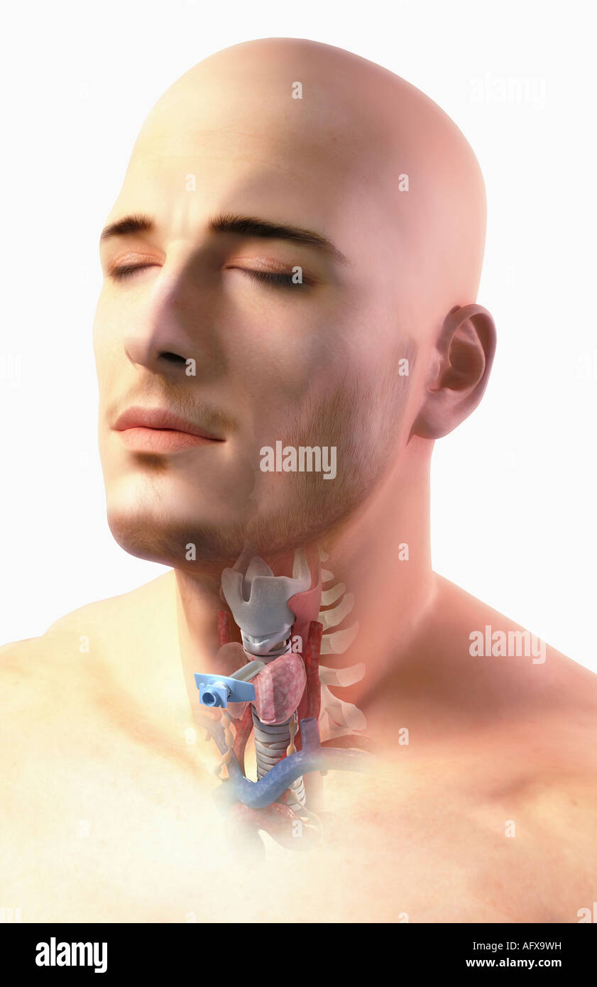 Tracheostomy tracheotomy immagini e fotografie stock ad alta ...