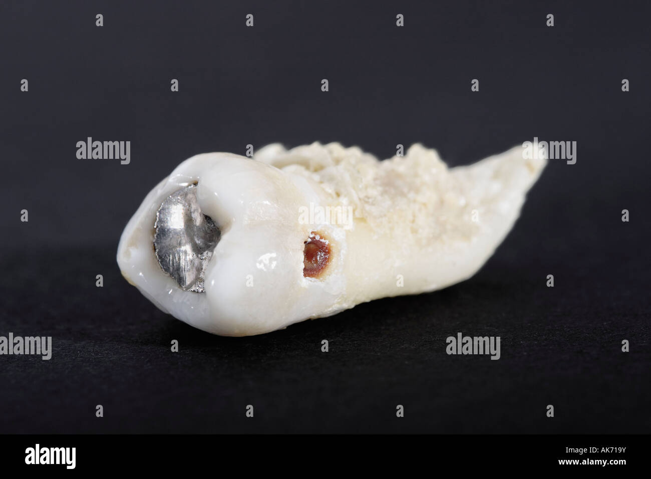 Dente cariato estratto immagini e fotografie stock ad alta risoluzione ...