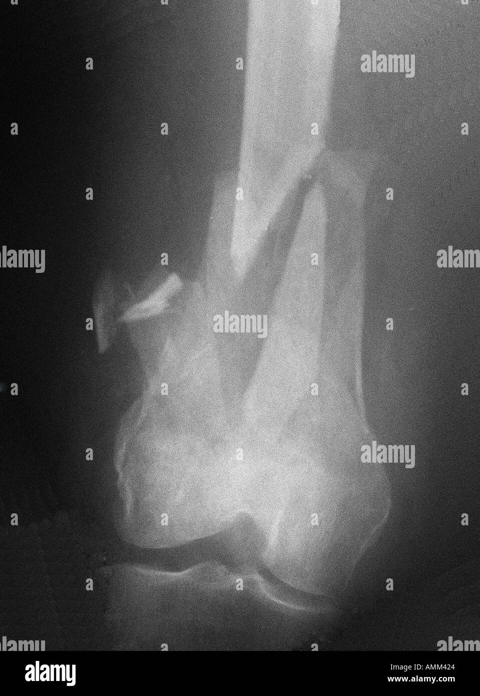 Frattura comminuta immagini e fotografie stock ad alta risoluzione - Alamy