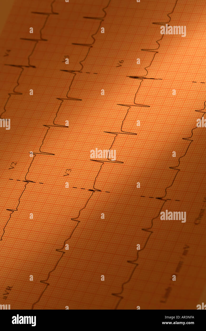 Ecg trace immagini e fotografie stock ad alta risoluzione - Alamy