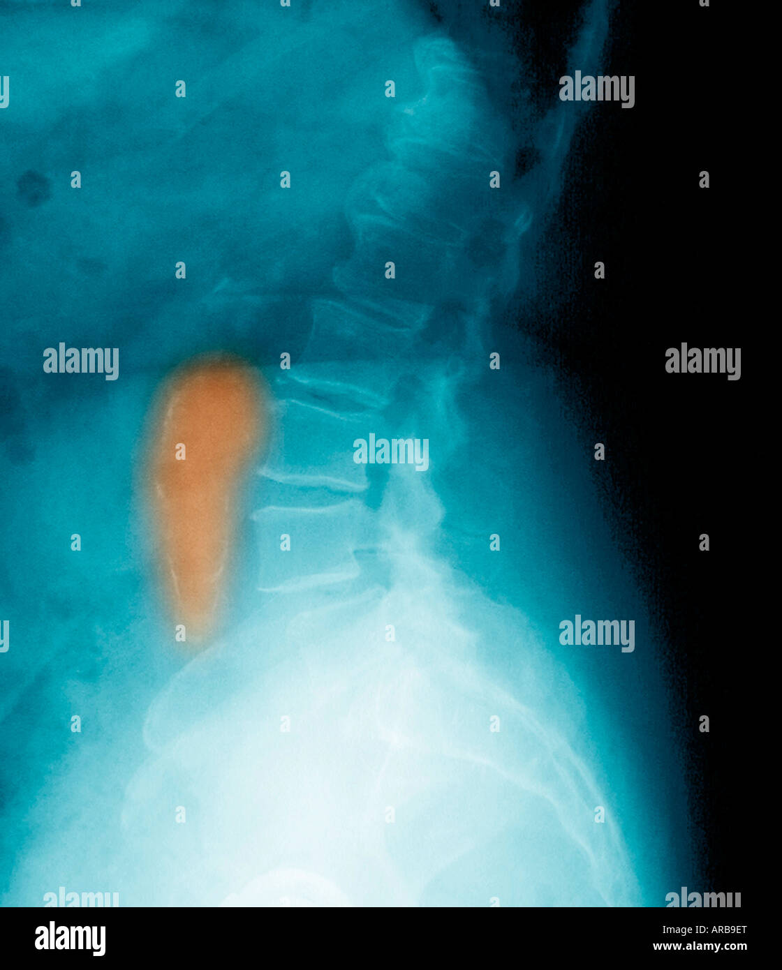 Aortic aneurysm immagini e fotografie stock ad alta risoluzione - Alamy