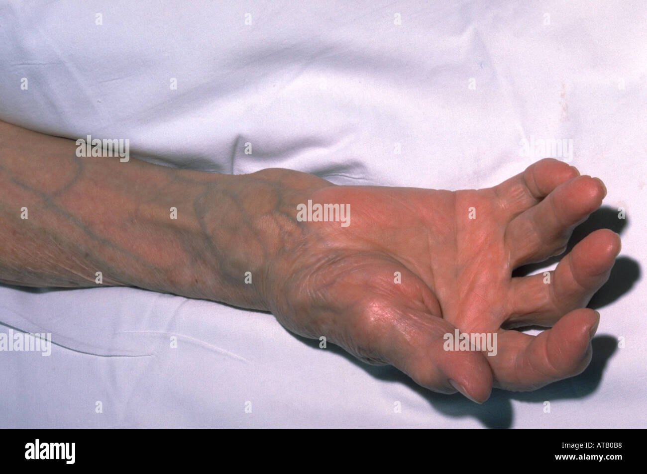 Sindrome da deperimento immagini e fotografie stock ad alta risoluzione ...