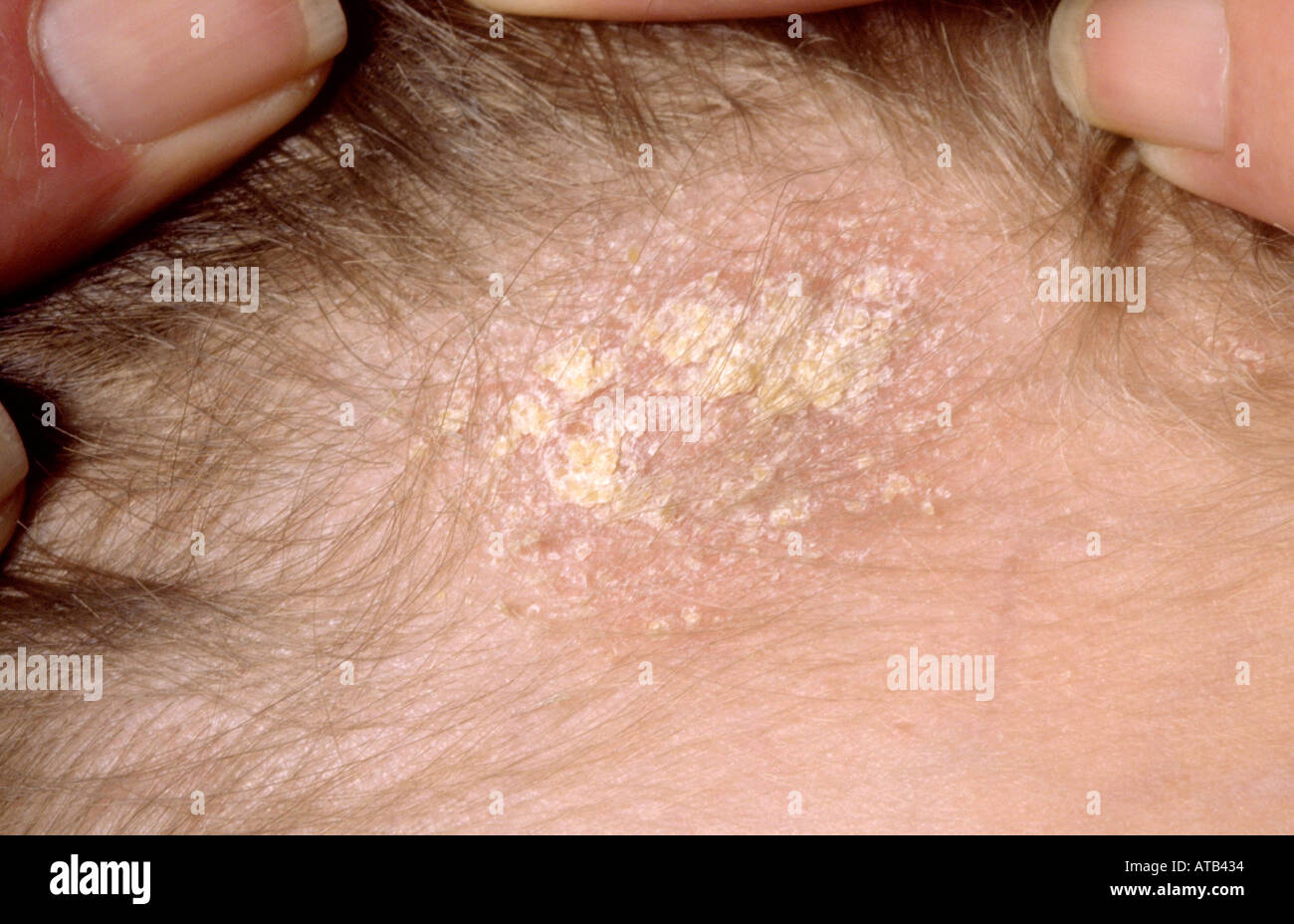 Tinea capitis immagini e fotografie stock ad alta risoluzione - Alamy