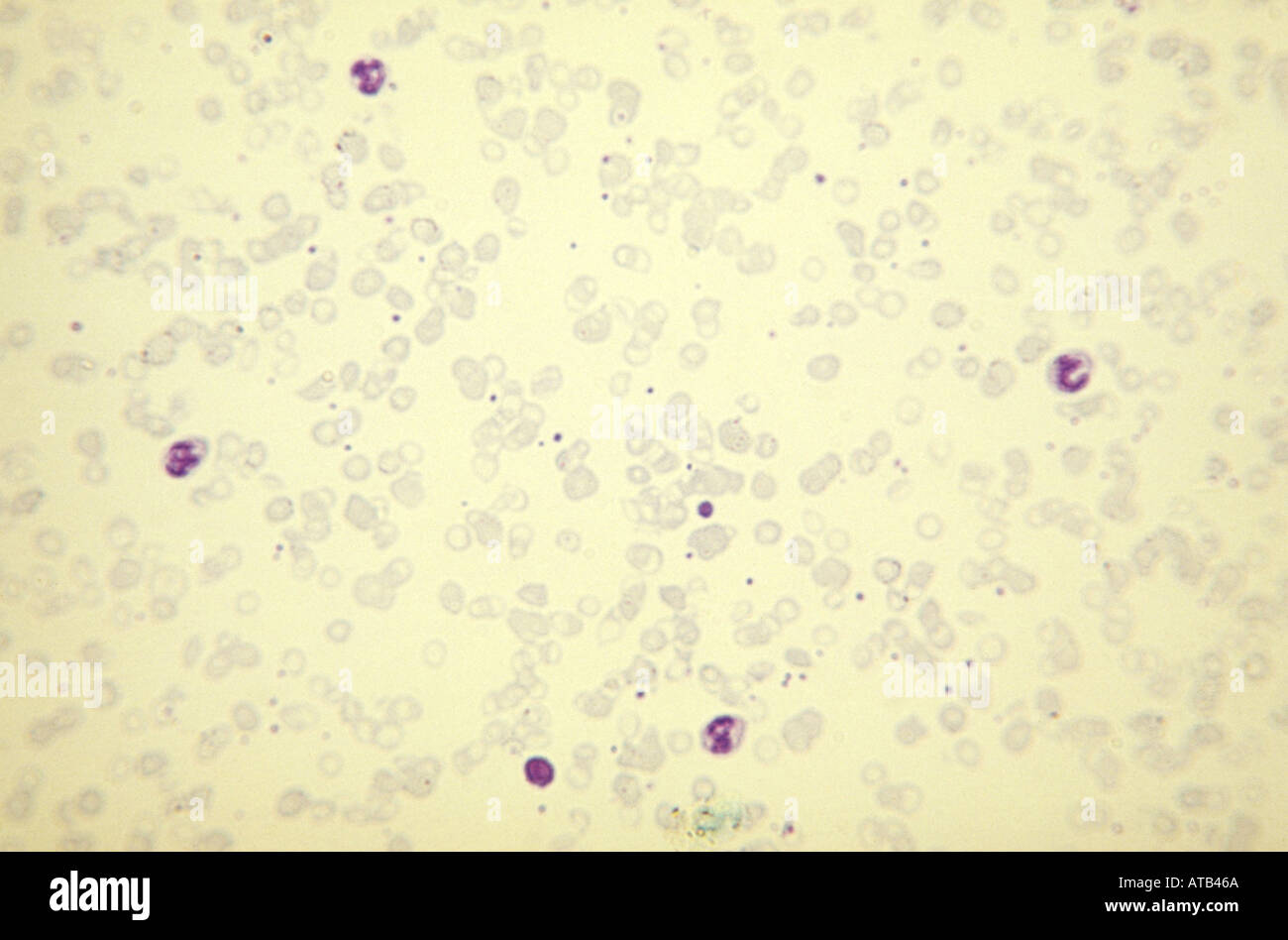 Anemia sideropenica immagini e fotografie stock ad alta risoluzione - Alamy