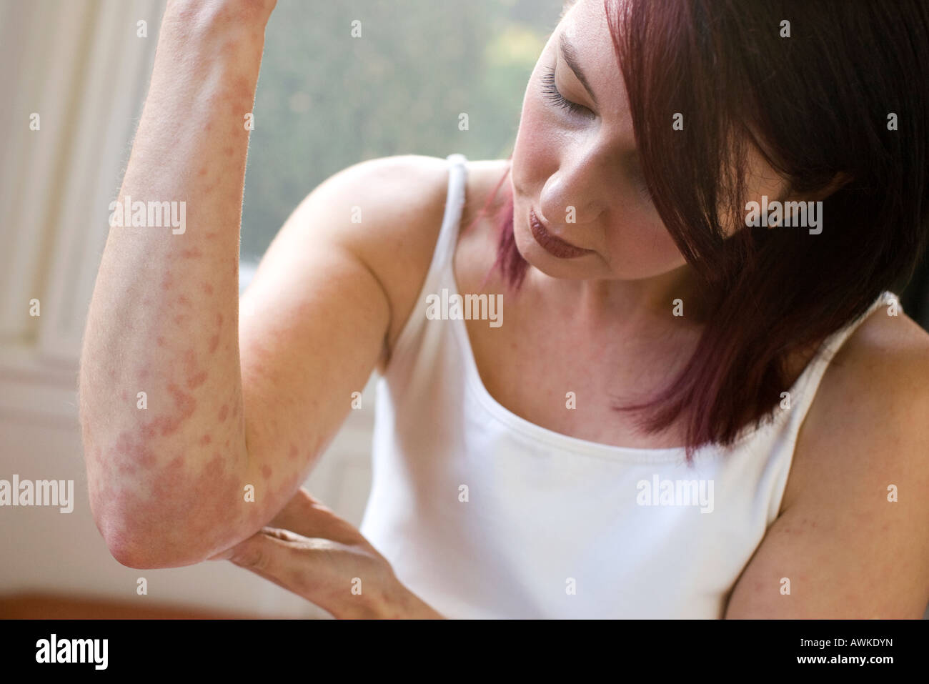 Eritema di herpes zoster a portata di mano immagini e fotografie stock ad alta risoluzione - Alamy