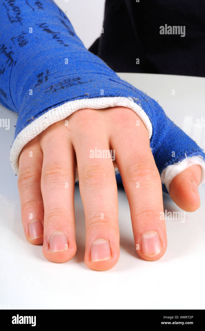Polso ingessato immagini e fotografie stock ad alta risoluzione - Alamy