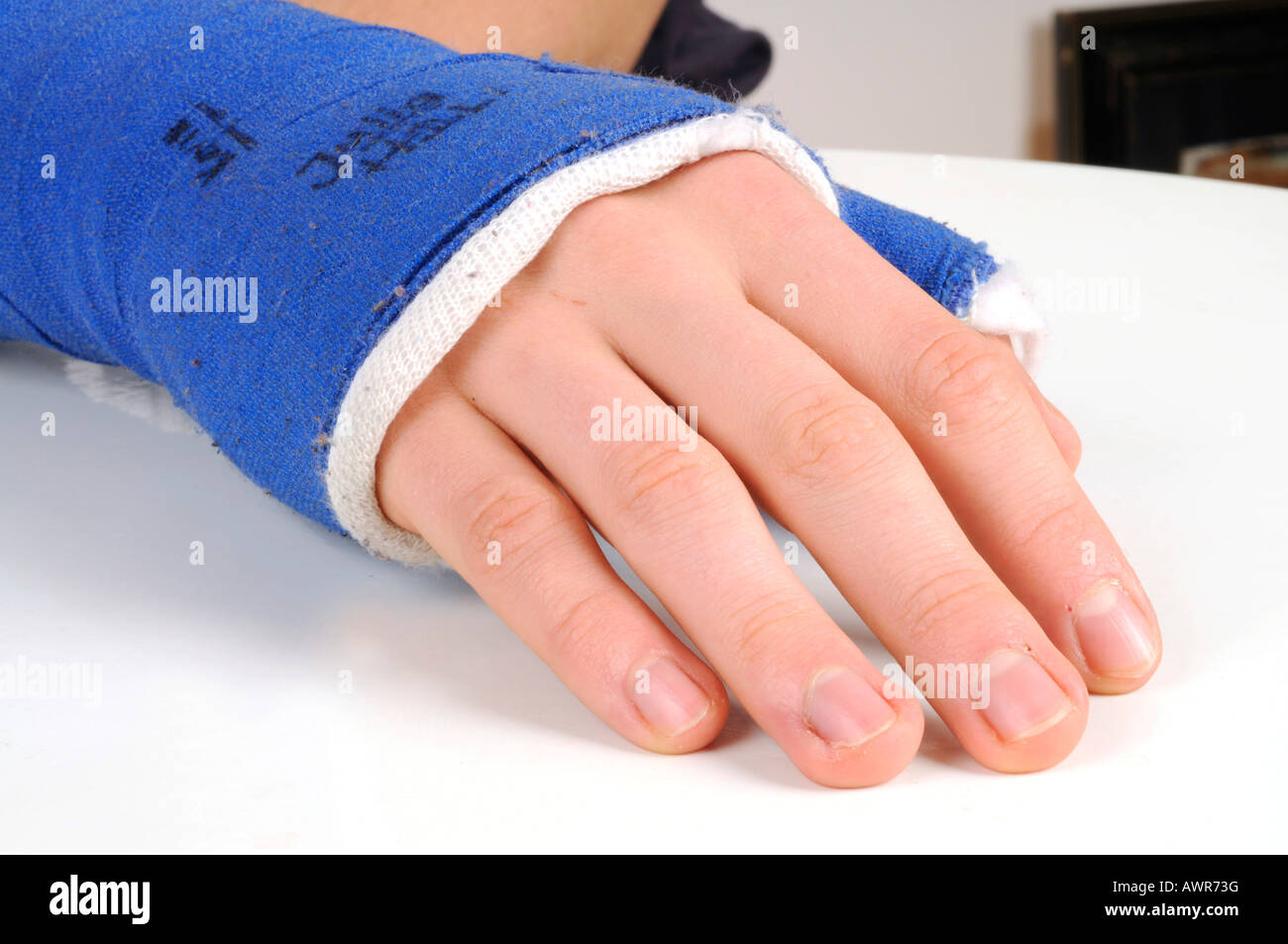 Arm in gips immagini e fotografie stock ad alta risoluzione - Alamy