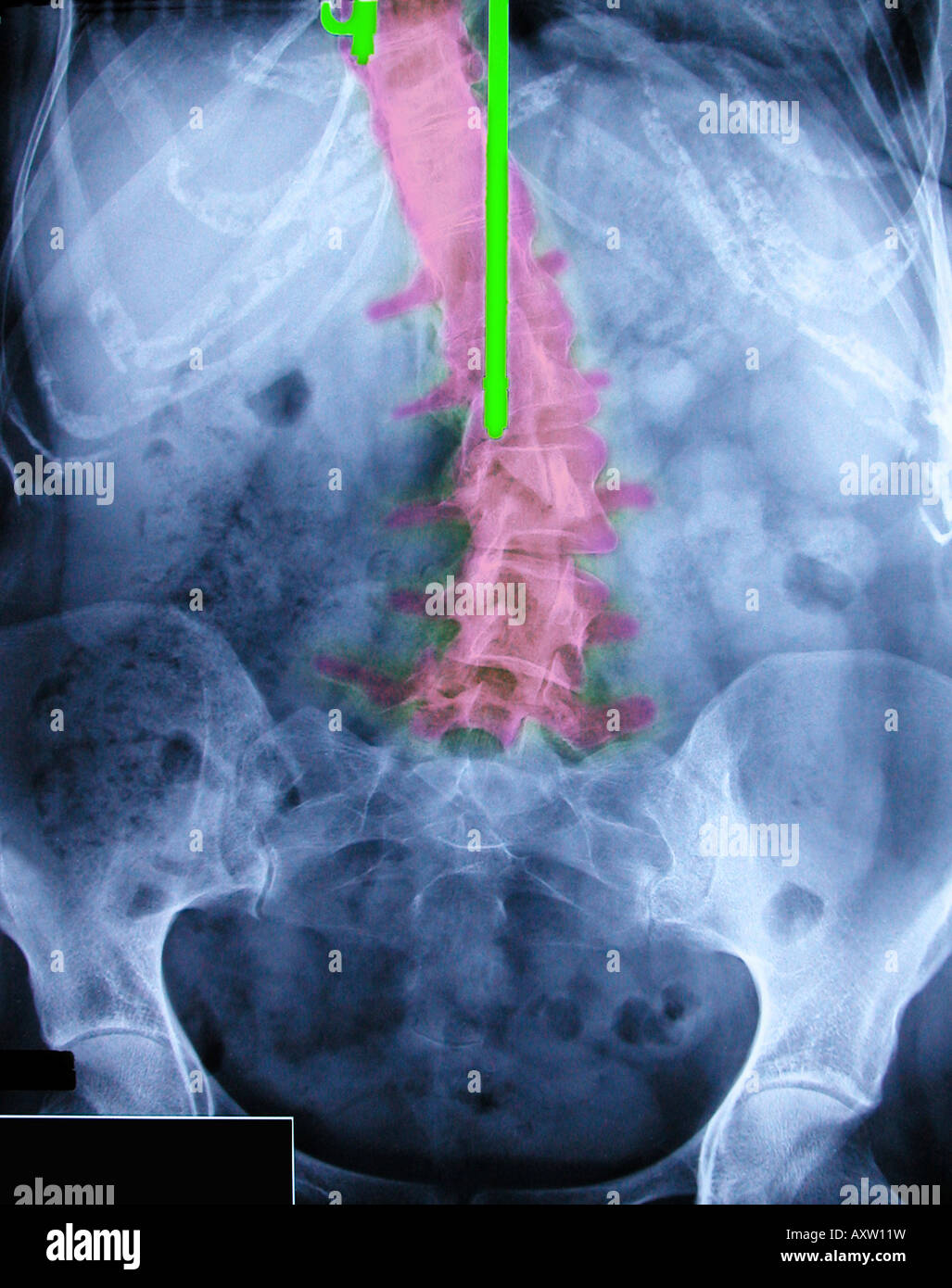 La colonna lombare x-ray di 33 yo paziente femmina con la scoliosi ...