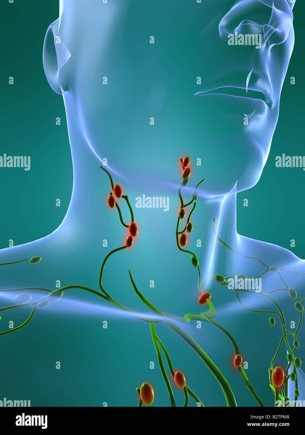 Linfonodi ingrossati immagini e fotografie stock ad alta risoluzione - Alamy