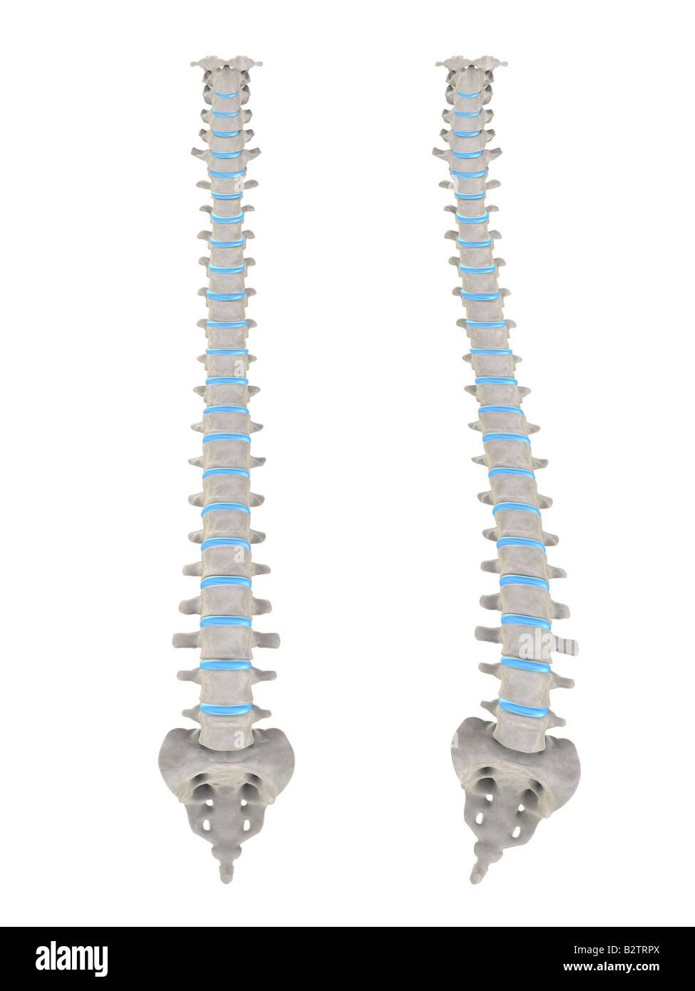 Scoliosis of the spine immagini e fotografie stock ad alta risoluzione ...