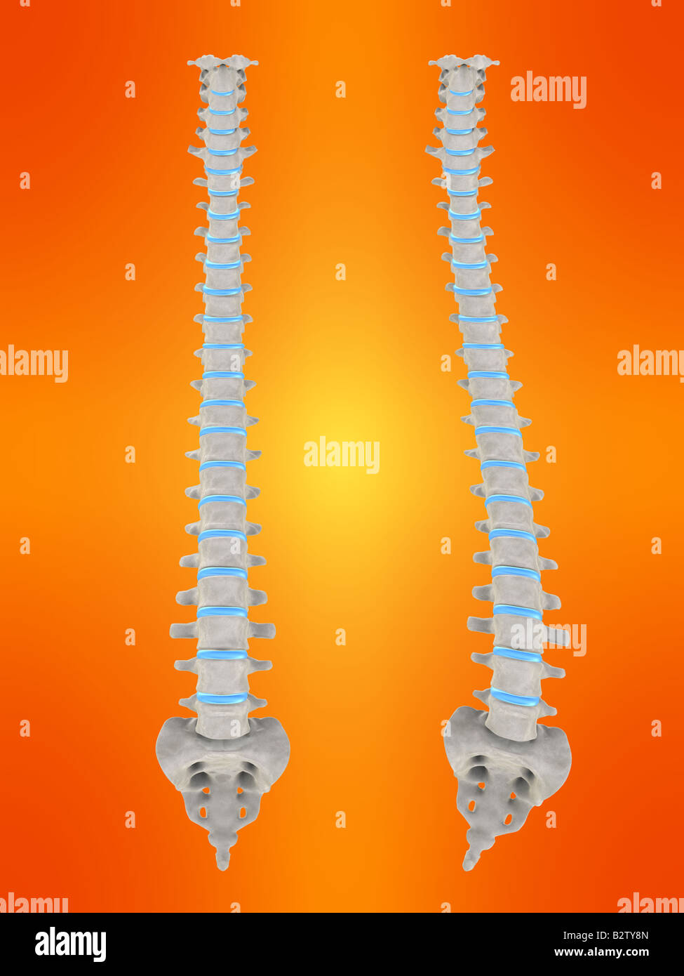 Scoliosis of the spine immagini e fotografie stock ad alta risoluzione ...