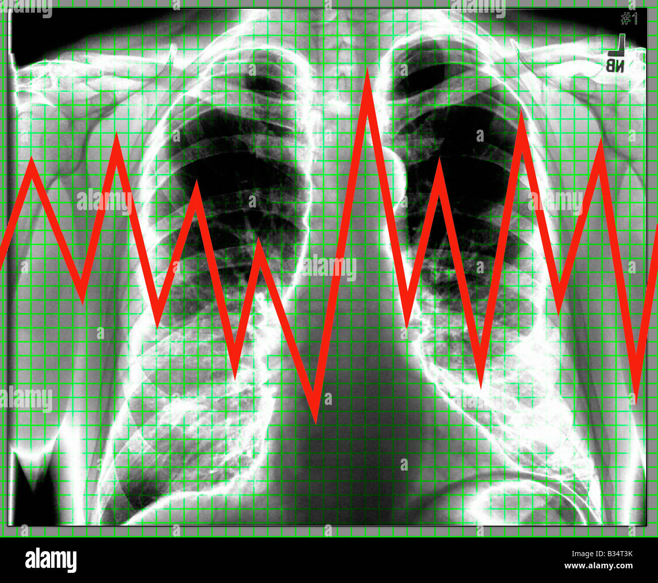 Codifica a colori i raggi x al torace con ECG elettrocardiogramma Foto ...
