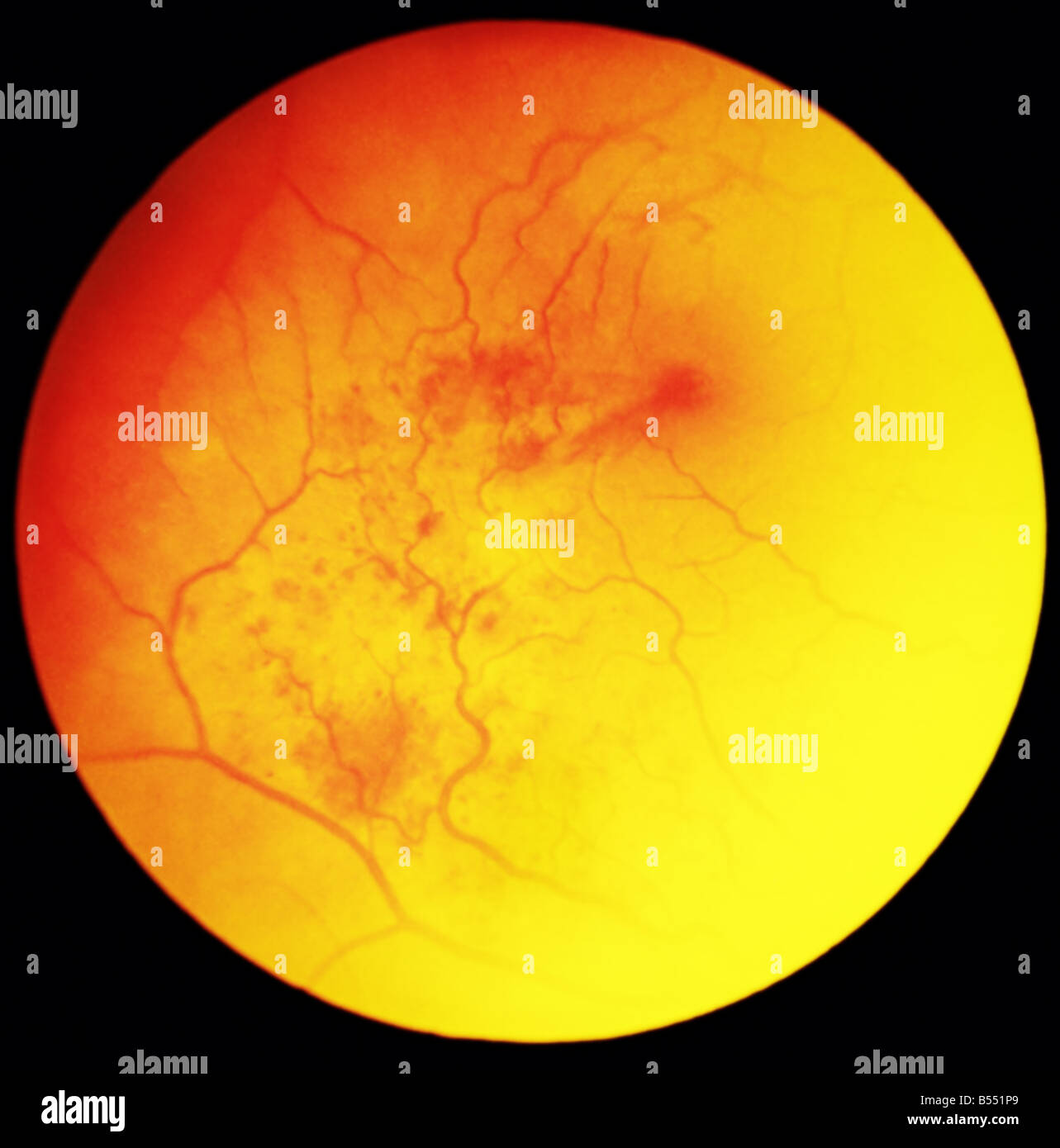 Emorragia oculare immagini e fotografie stock ad alta risoluzione - Alamy