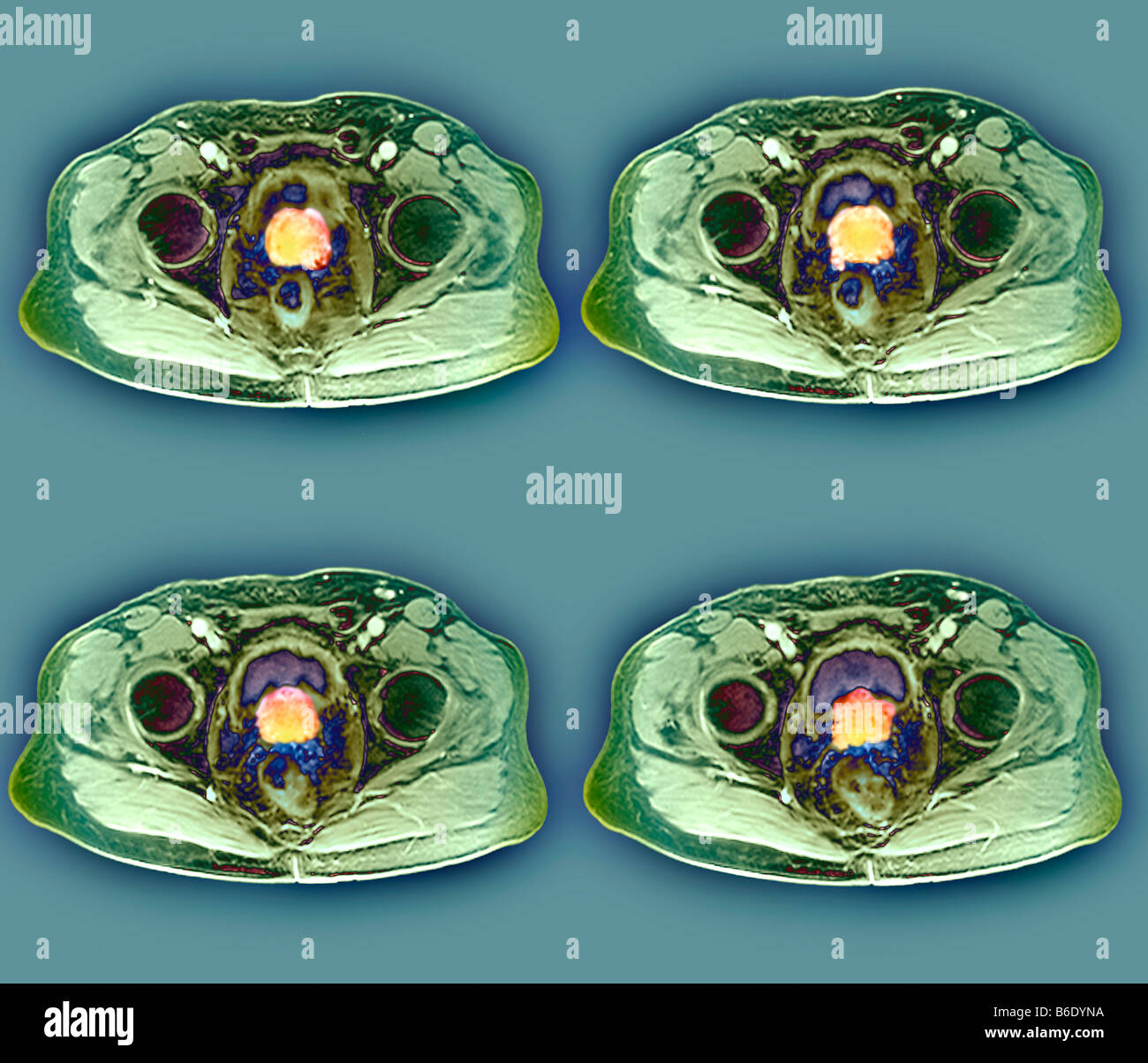 Risonanza magnetica basso addome immagini e fotografie stock ad alta ...