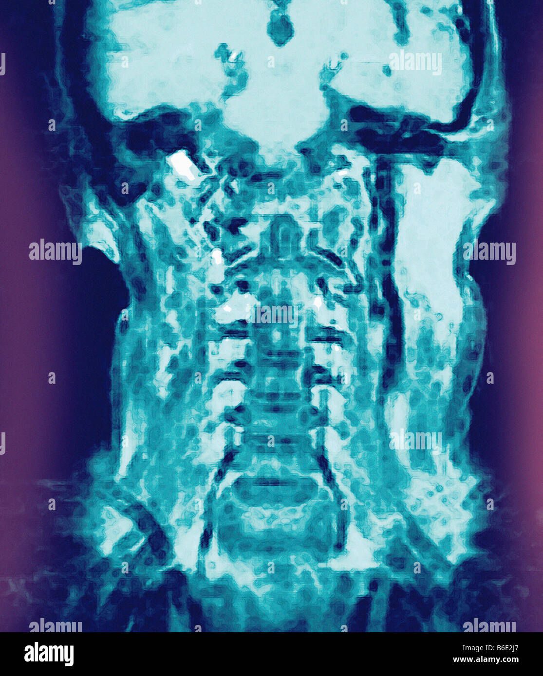 Risonanza magnetica rachide cervicale immagini e fotografie stock ad ...