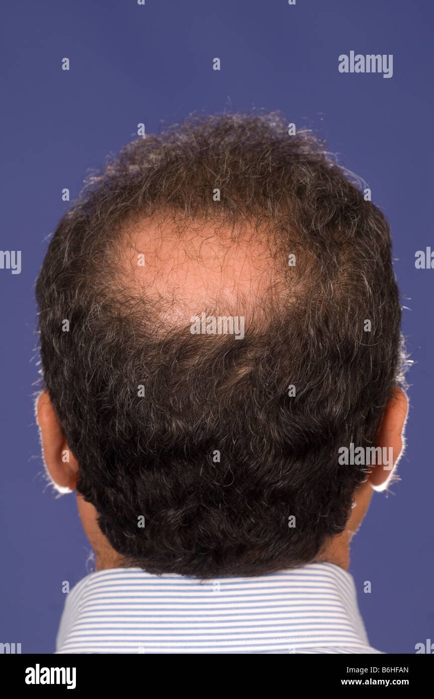 Modello di alopecia immagini e fotografie stock ad alta risoluzione - Alamy