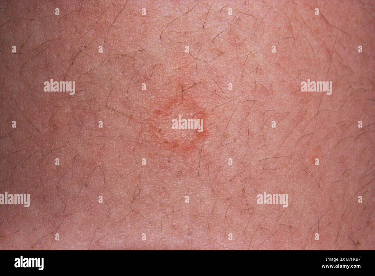 Infezione da tigna immagini e fotografie stock ad alta risoluzione - Alamy