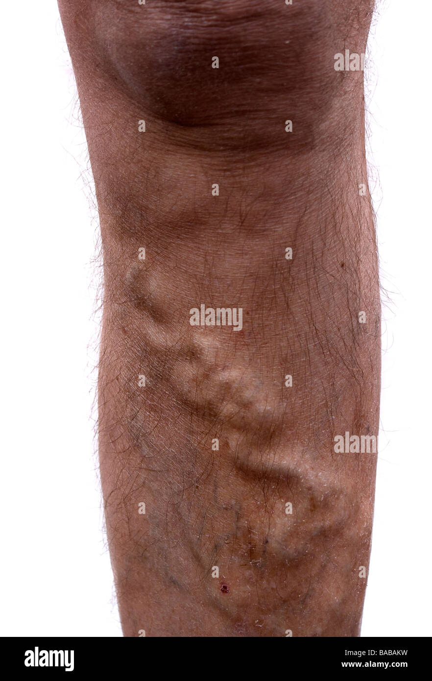 Vena varicosa immagini e fotografie stock ad alta risoluzione - Alamy