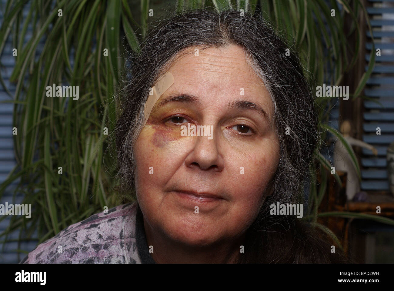 Occhio nero immagini e fotografie stock ad alta risoluzione - Alamy