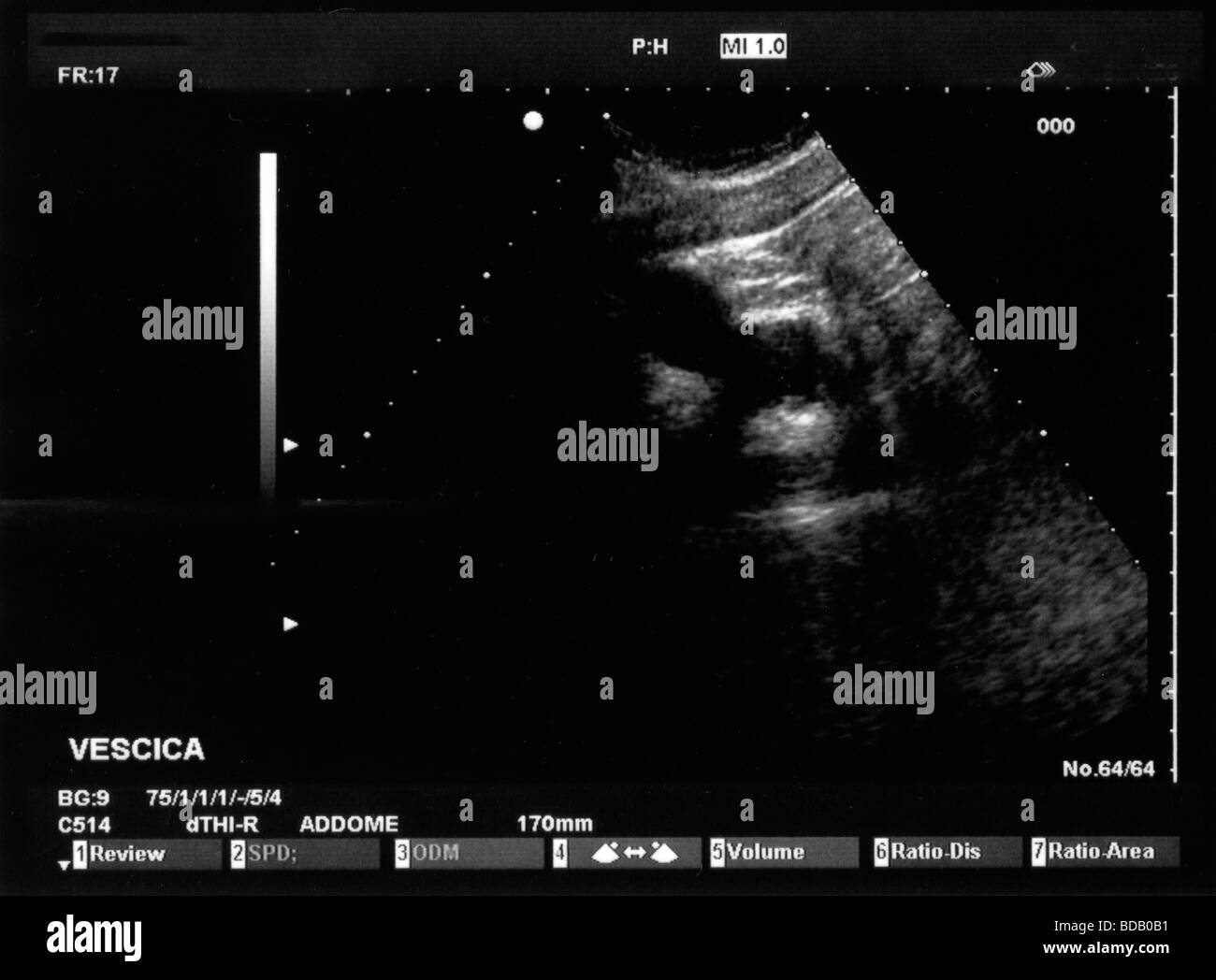 Ecografia della vescica immagini e fotografie stock ad alta risoluzione ...